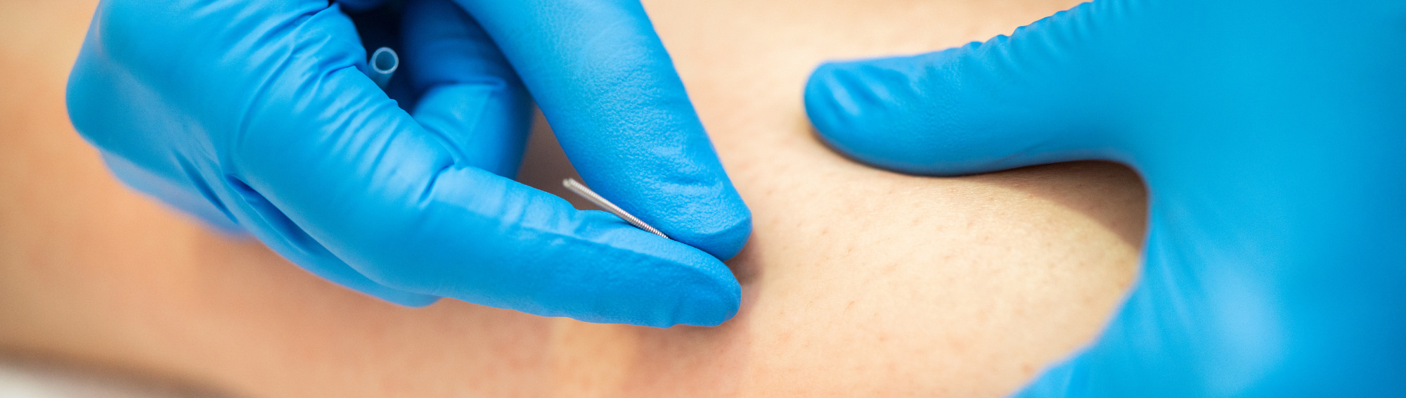 Dry Needling Program - ORA Orthopedics